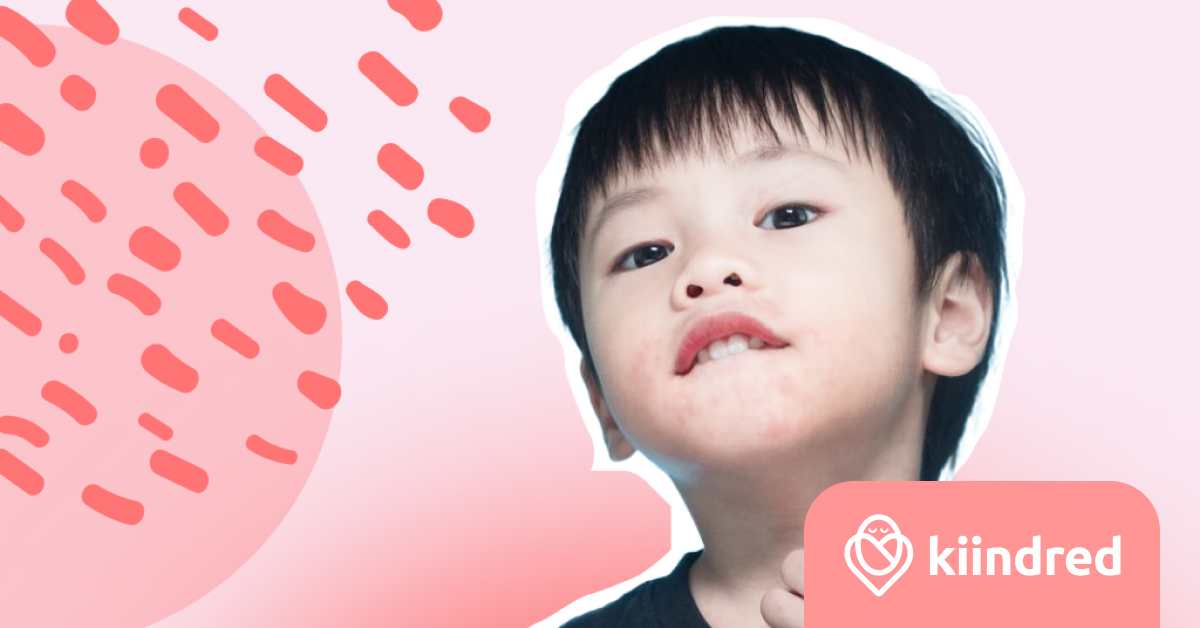 Heat Rashes What You Need To Know About Kiindred