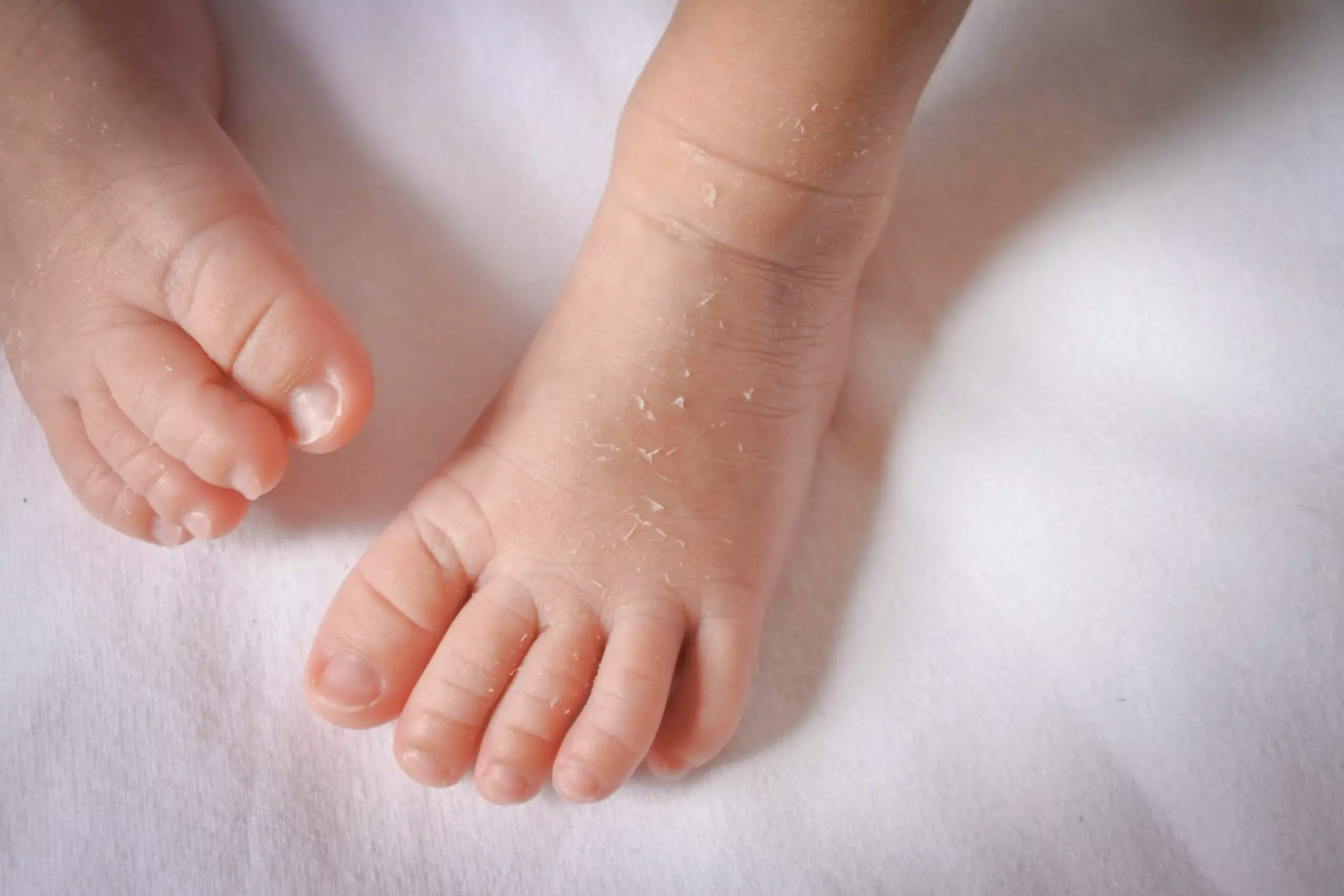 Understanding eczema in babies | Kiindred